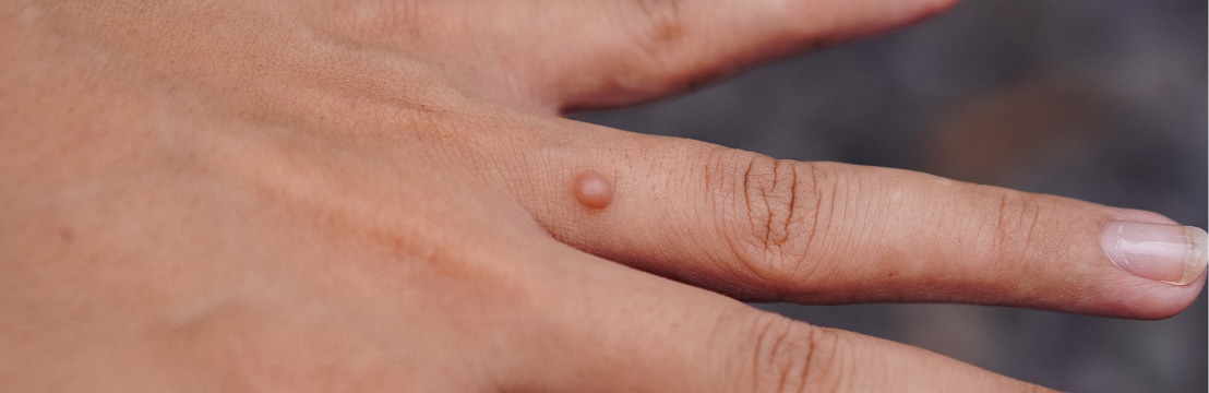 Warts Fredericksburg TX - Warts Treatment Fredericksburg TX