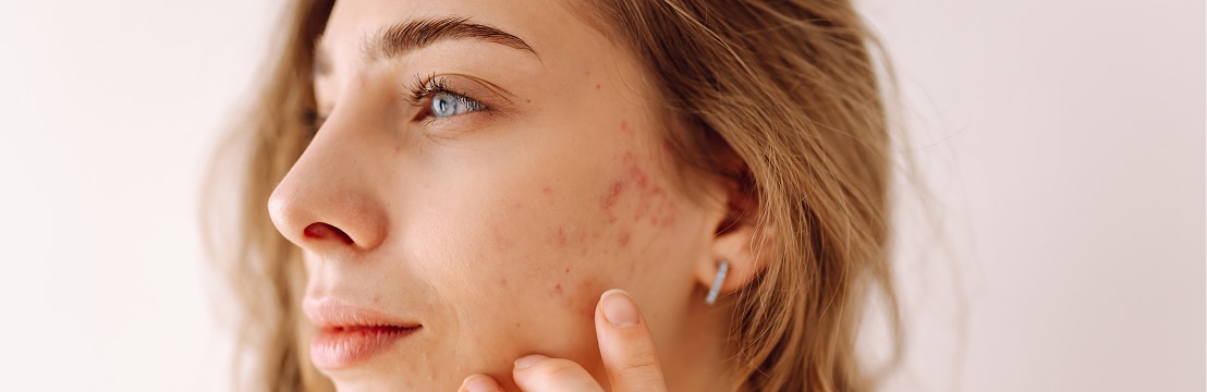 Acne (Children and Adults) Fredericksburg TX - Acne Care
