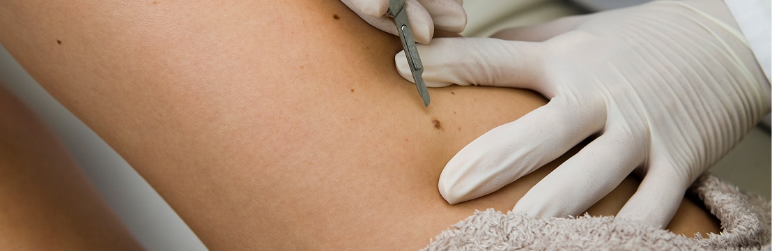 Regular Skin Cancer Excision Fredericksburg TX