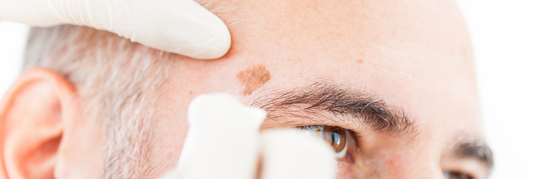 Removing Age/ Wisdom Spots Fredericksburg TX